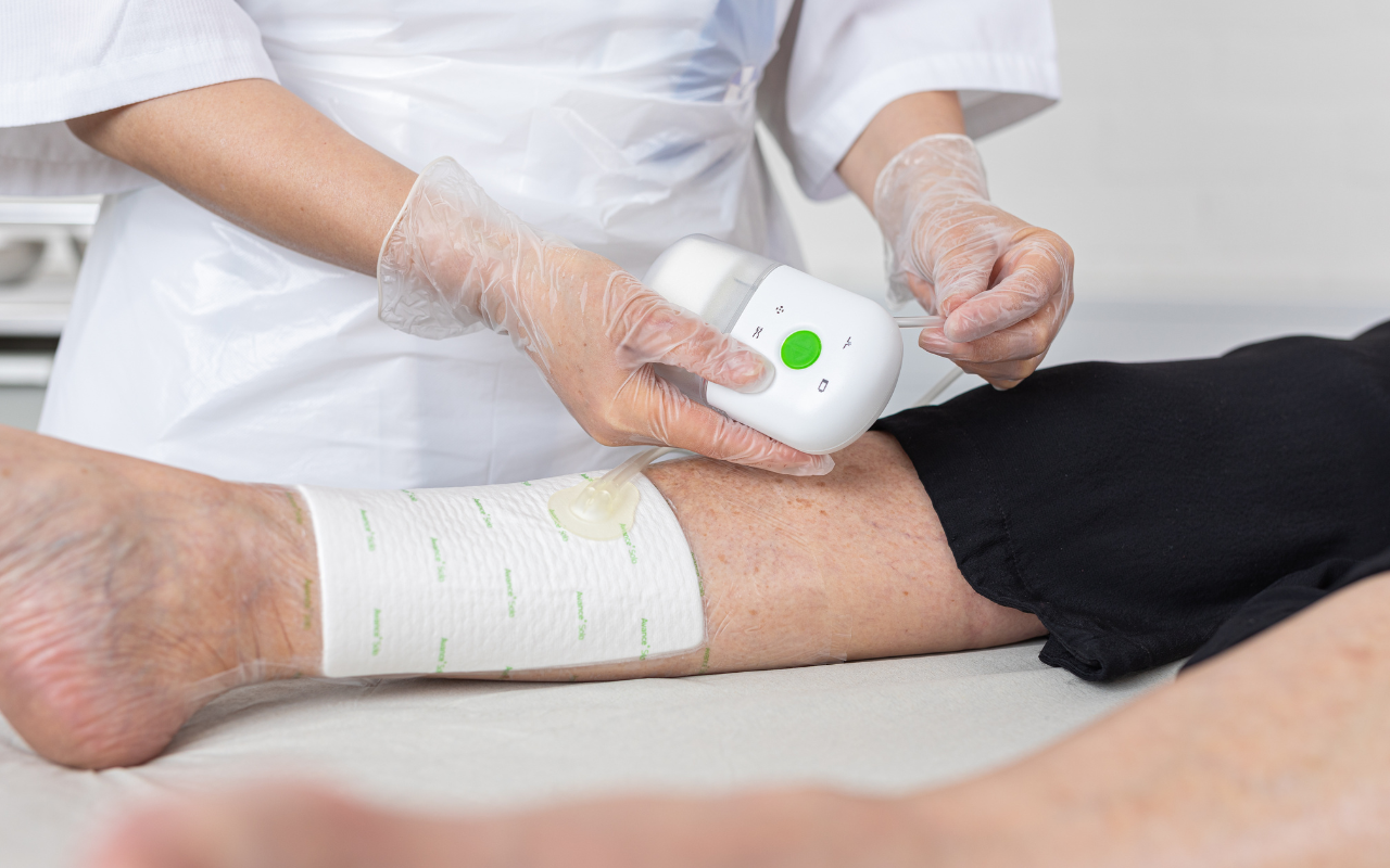 Podtlaková terapie (NPWT) patří k moderním metodám léčby při hojení ran ...